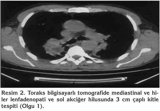 Pn?mokonyozlu hastalarda malign hastal??? taklit eden yanl?? pozitif ...